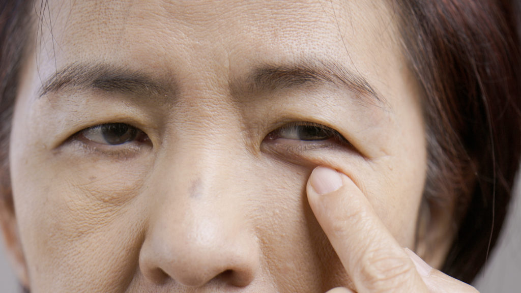 What Causes Ptosis? | Mccracken Eye And Face Institute